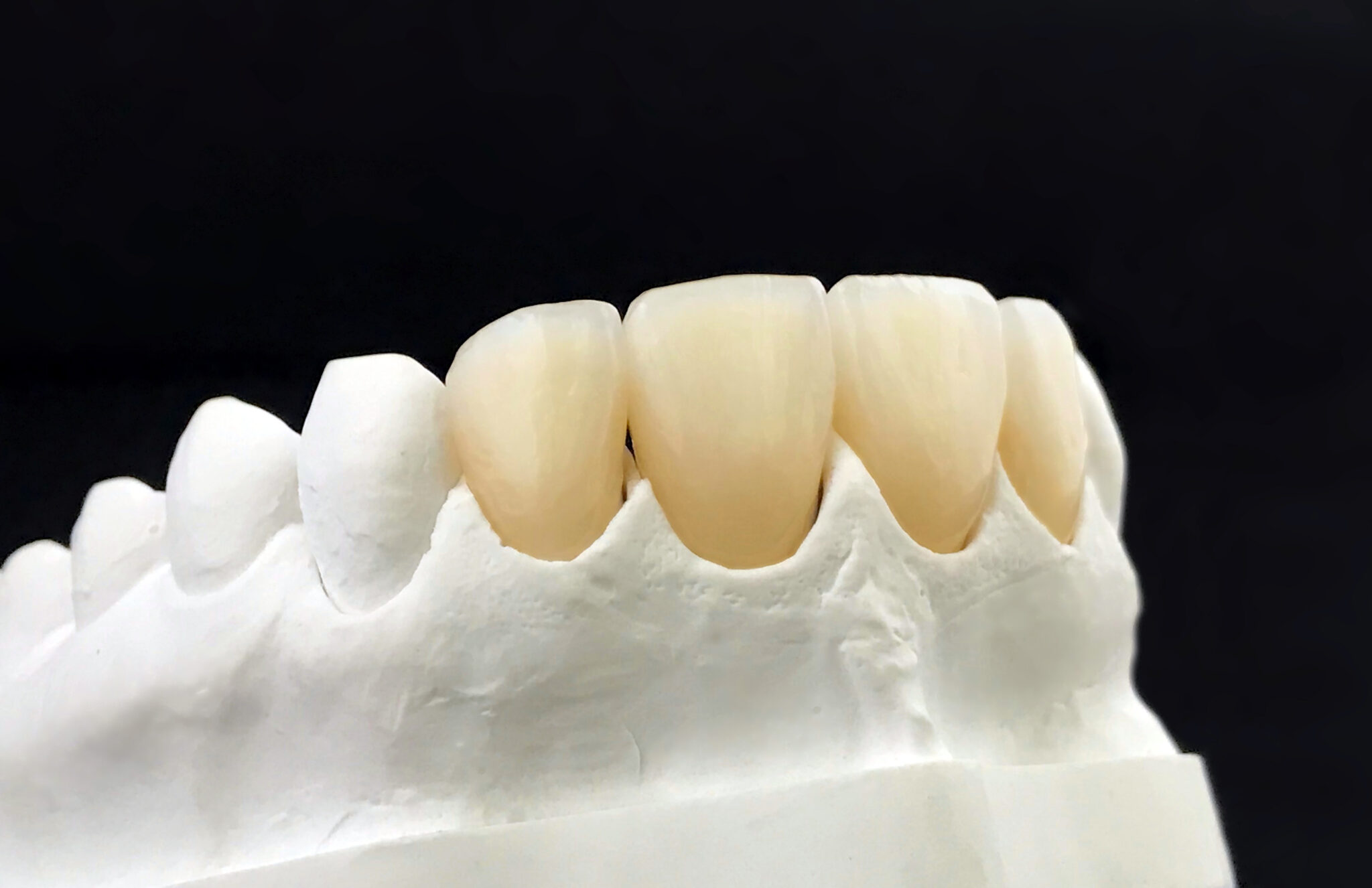 Porcelain Veneers Could Makeover Your Smile | Houston, TX